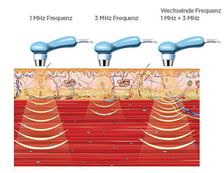 Ultraschalltherapie